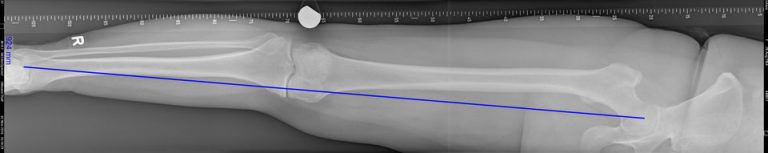 Kniearthrose (Gonarthrose) behandeln